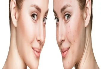 Best affordable Infinity Peel Acne Treatment Session treatment for ...